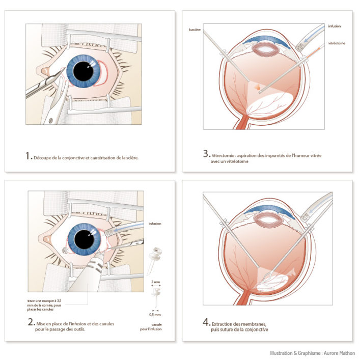 Illustration médicale - Aurore Mathon - PORTFOLIO
